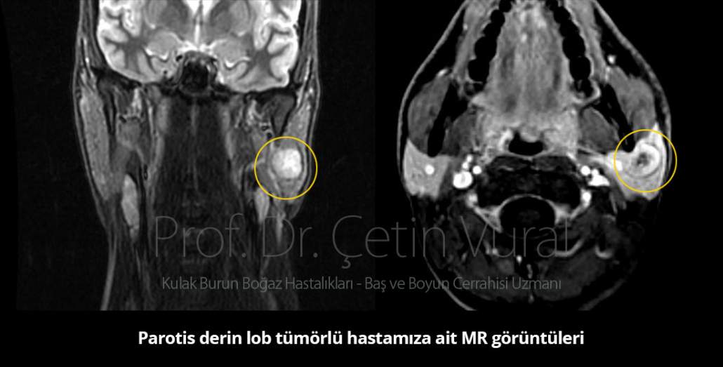 Tükürük Bezi Tümörleri ve Tedavisi - Prof. Dr. Çetin Vural