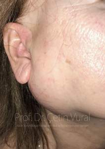 Tükürük Bezi Tümörleri - Prof. Dr. Çetin Vural