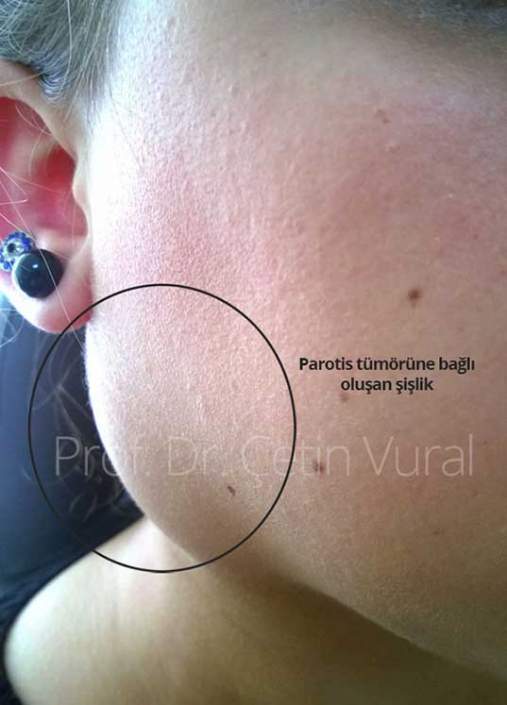 Tükürük Bezi Tümörleri - Prof. Dr. Çetin Vural