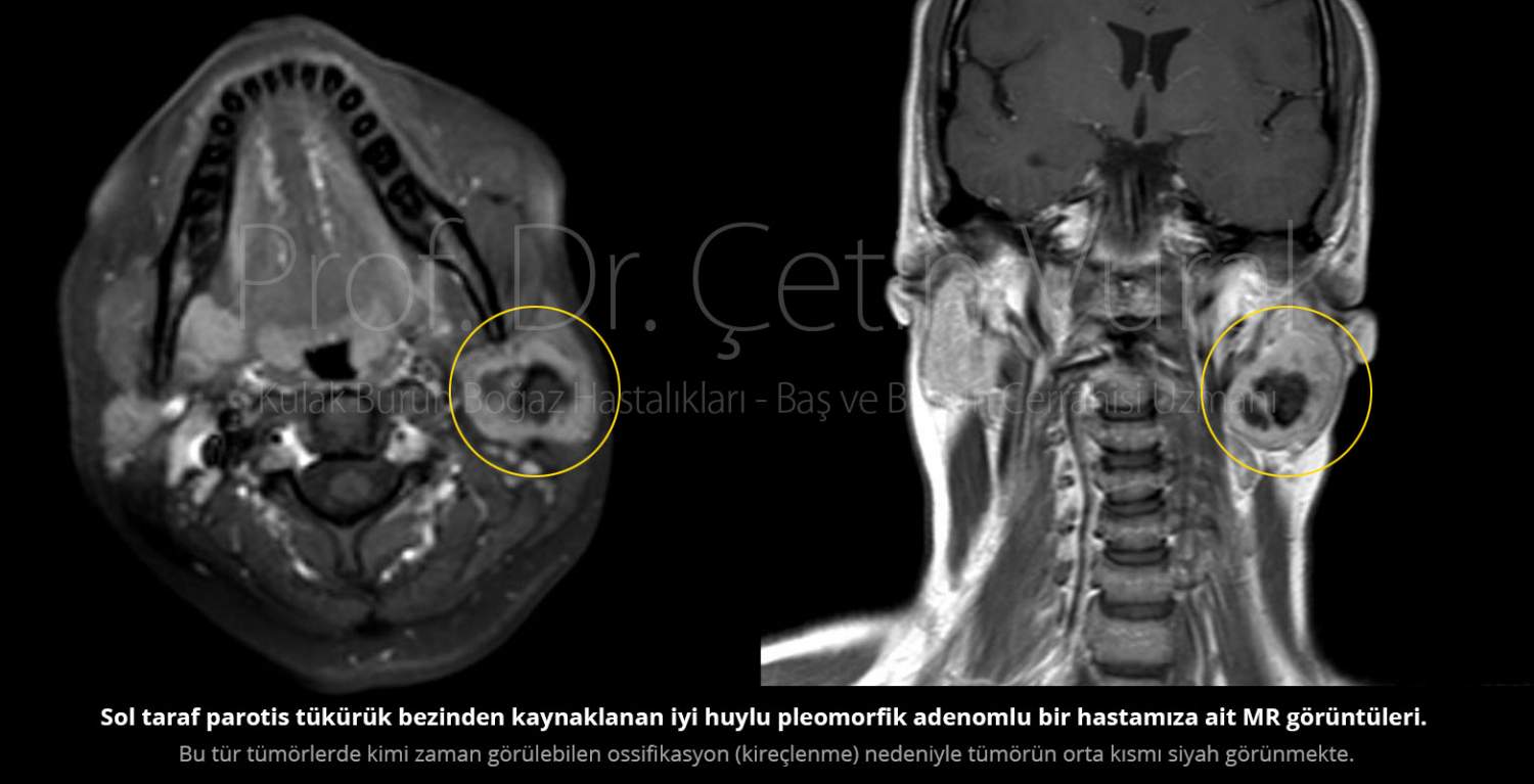 Tükürük Bezi Tümörleri ve Tedavisi - Prof. Dr. Çetin Vural
