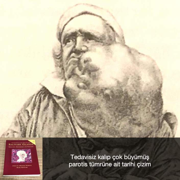 Tükürük Bezi Tümörleri - Prof. Dr. Çetin Vural