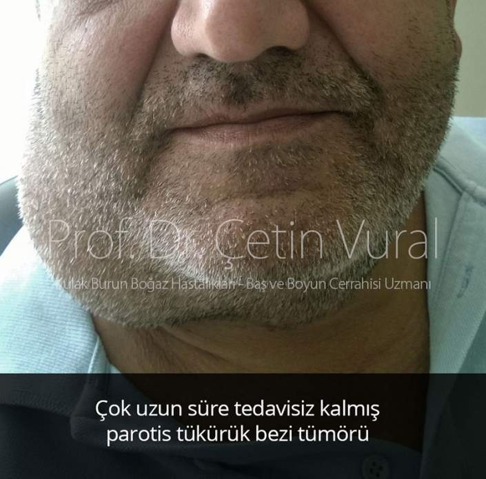 Tükürük Bezi Tümörleri - Prof. Dr. Çetin Vural