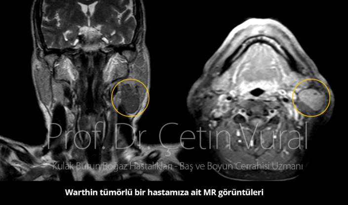 Tükürük Bezi Tümörleri ve Tedavisi - Prof. Dr. Çetin Vural