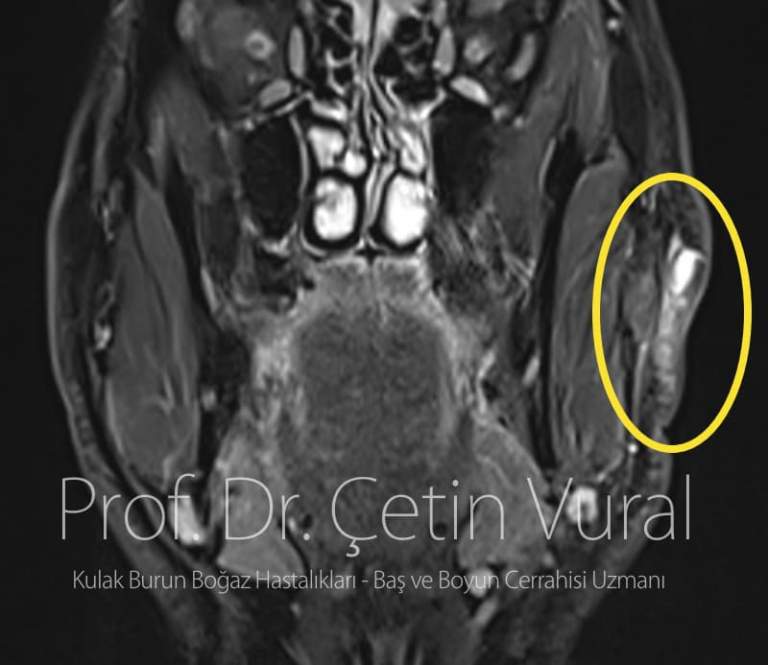 Parotis Tükürük Bezi Yüzeyinde İnfundibuler Kist - Prof. Dr. Çetin Vural