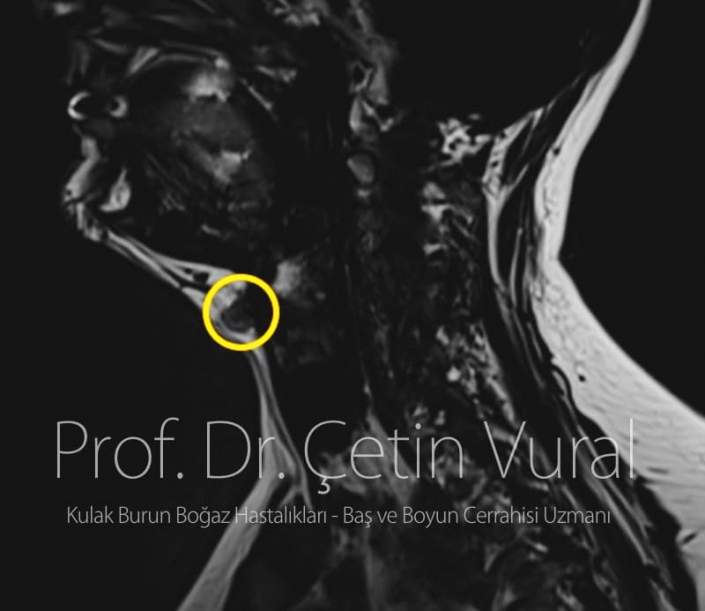 Boyun Üst Kısımda Epidermal Kist - Prof. Dr. Çetin Vural