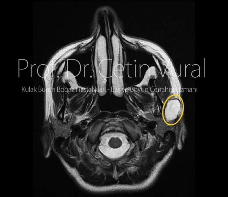 Sol Parotis Tükürük Bezinde Pleomorfik Adenom Cerrahisi - Prof. Dr ...