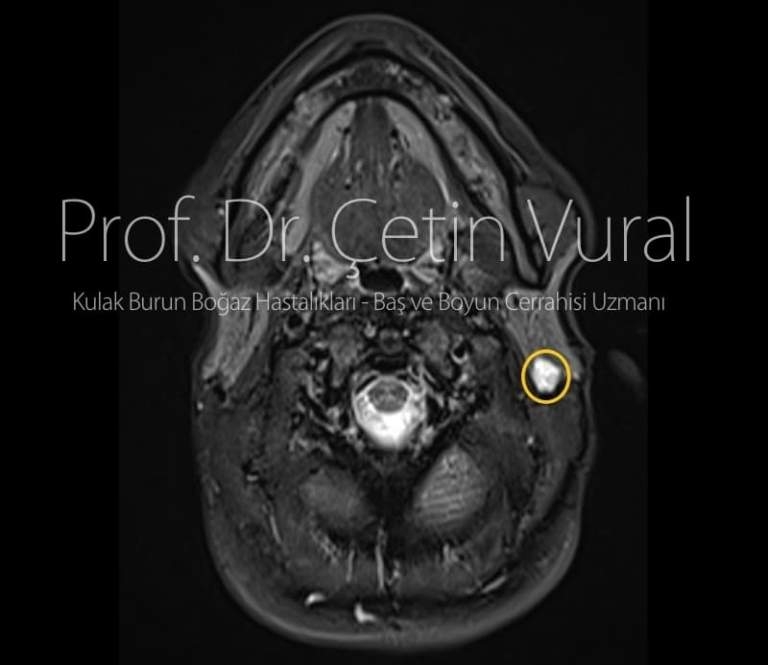 Sol Parotis Tükürük Bezinde Pleomorfik Adenom Cerrahi Tedavisi - Prof ...